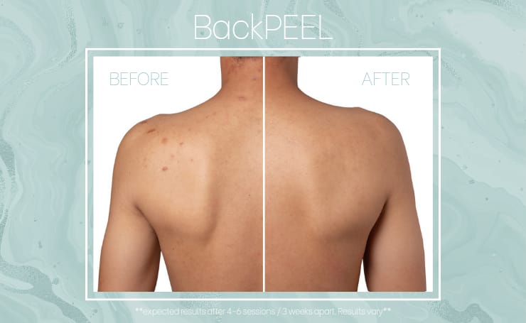 Back Peel Treatment Benefits | Dérmica MedEsthetics, Edmonton